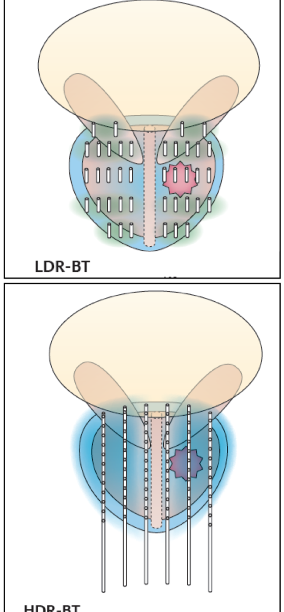 HDR vs LDR Brachytherapy - Is One Better Than The Other - Prostate ...
